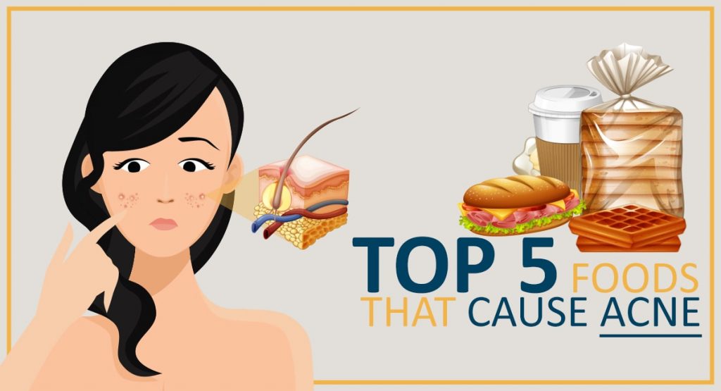 Acne and Diet: Top 5 Foods to Avoid If You Have Acne - To Depth